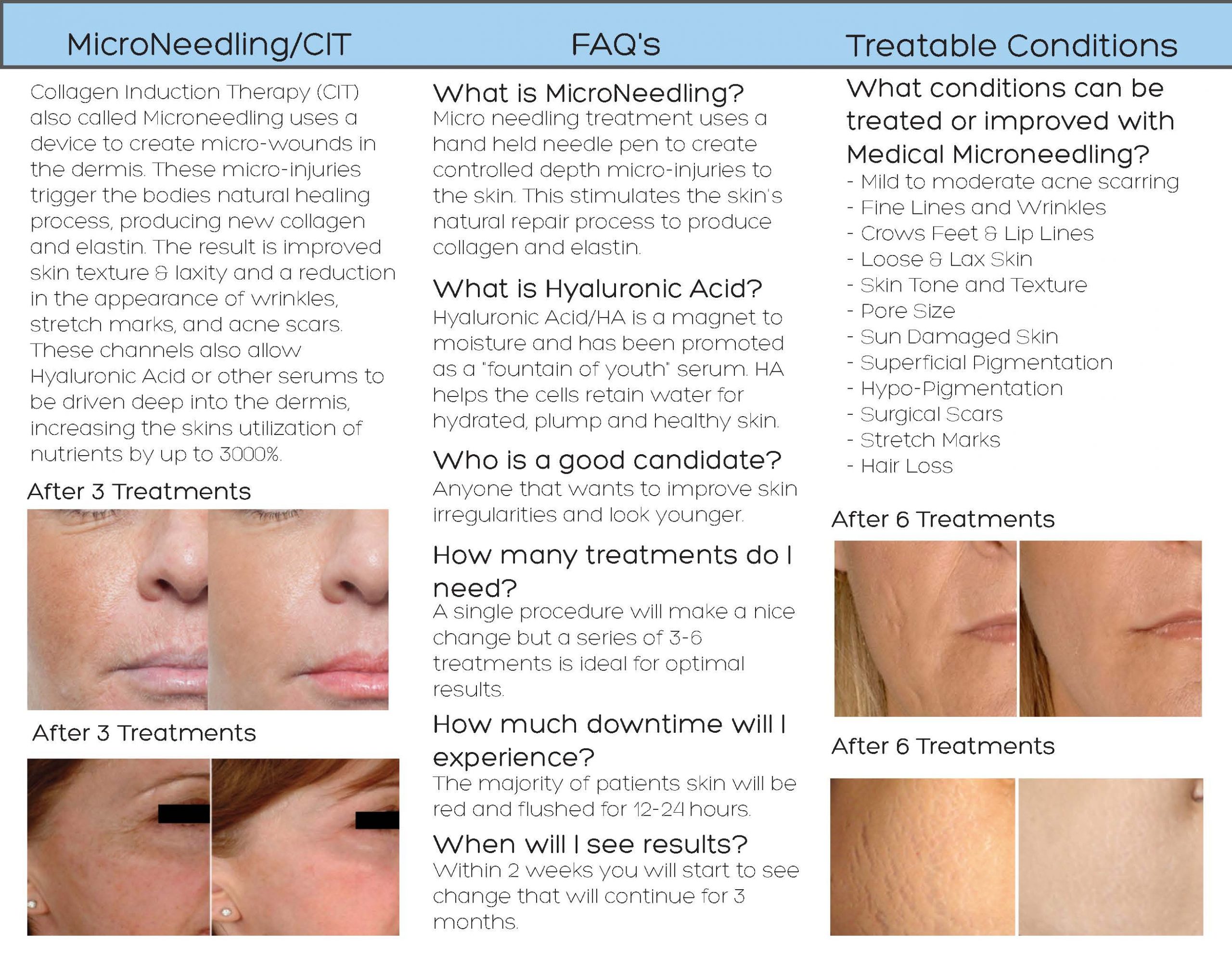 MicroNeedling Brochures with Hyaluronic Acid - MD Needle Pen